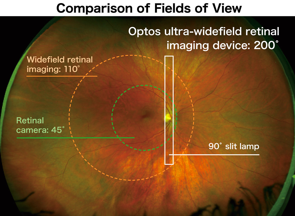 Ultra-Wide Field Retinal Imaging Device | Product Technology | Nikon ... Ultra-Wide Field Retinal Imaging Device | Product Technology | Nikon ...